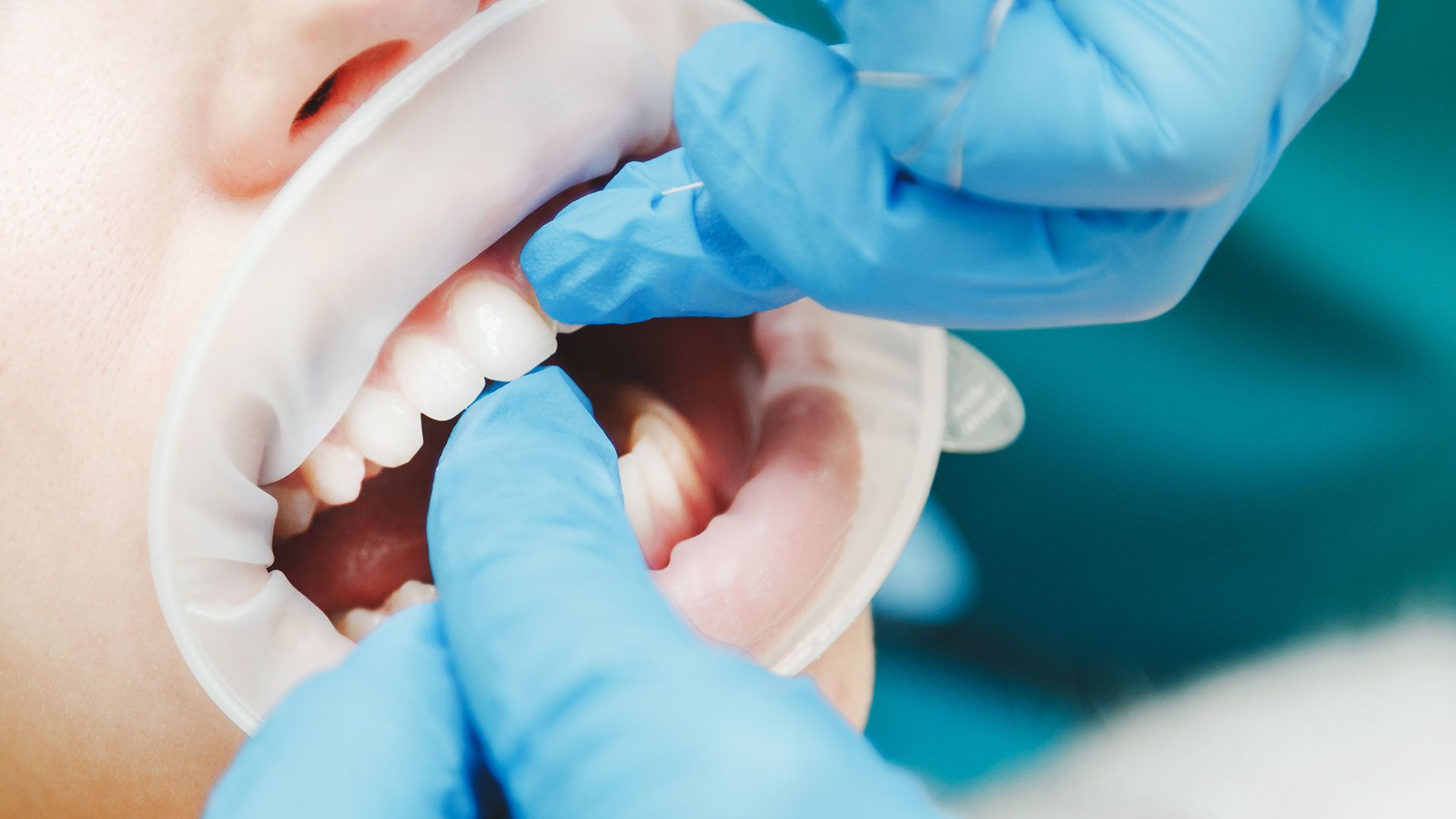 Chiuretaj parodontal dinte mobil cu LASER EPIC X - MedTime